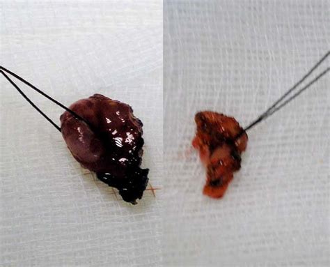 Operatory Product Of Maxillary Epulis Excision Download Scientific