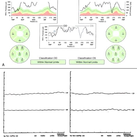 Brain Ct Scan Hypodensity And Loss Of Gray White Matter Download