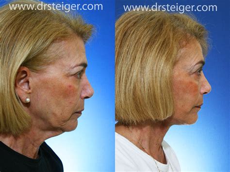 Facelift Before And After Photos Deep Plane Facelift