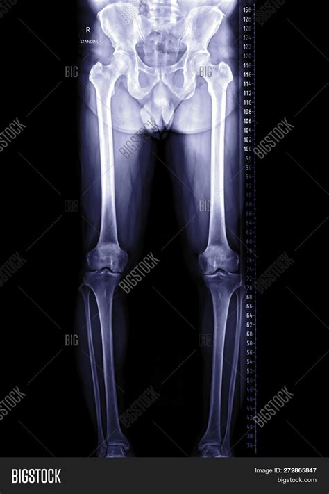 Scanogram Lower Limb X Image And Photo Free Trial Bigstock