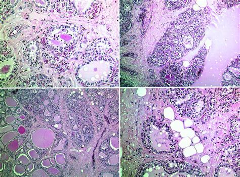Thyroid Gland Showing Pronounced Fibrosis With Inactive And Active