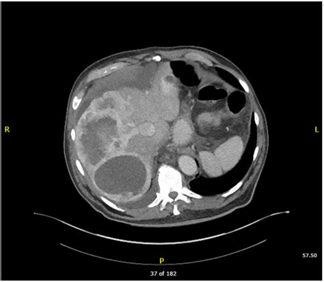 computed tomography scan revealing extensive hepatic metastases