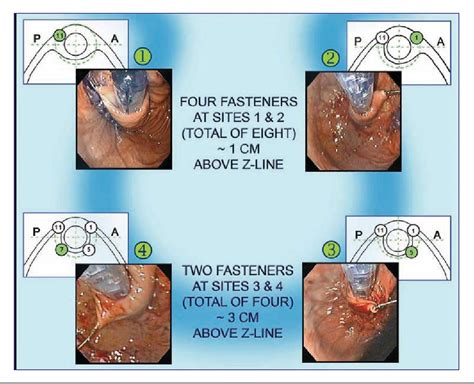 Figure 1 From Transoral Incisionless Fundoplication Offers High Patient