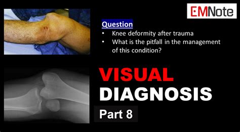 Pitfalls Of Traumatic Knee Dislocation Key Points Available In The
