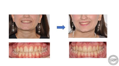 Incisor Classification Why Its Important Badov Orthodontics