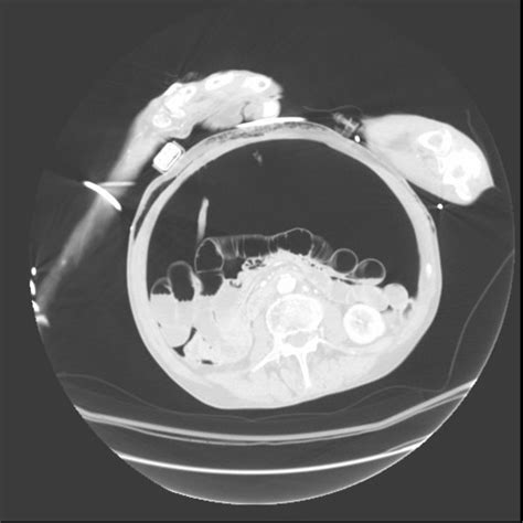 Pdf Emergency Percutaneous Needle Decompression For Tension Pneumoperitoneum