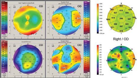 Getting Astigmatism In Focus With Advanced Imaging