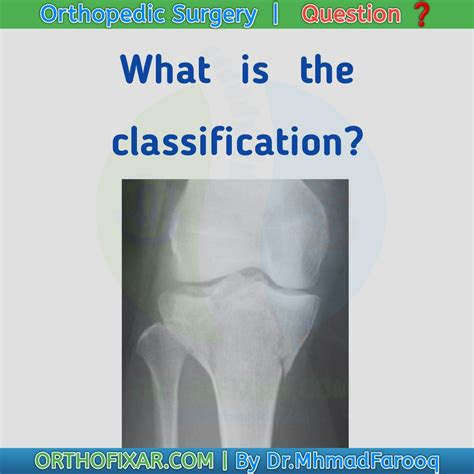 Orthofixar Orthopedic Surgery Orthopedic Surgery ☠☠ What Is This Fracture Classification