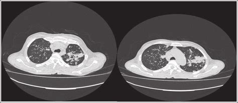 Hrct Chest Suggests A Cavitary Lesion In The Apicoposterior Segment Of Download Scientific