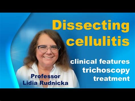 Dissecting Cellulitis