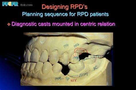 7designing Rpds Planning Sequence For Rpd Patients Ppt