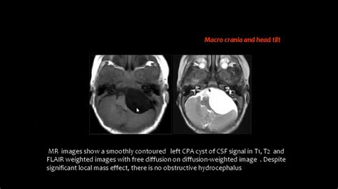 Posterior Fossa Mass Effect Cysts Neuro