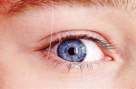Genetic Mutation In Human Eyes Genetic Mutation In Human Eyes