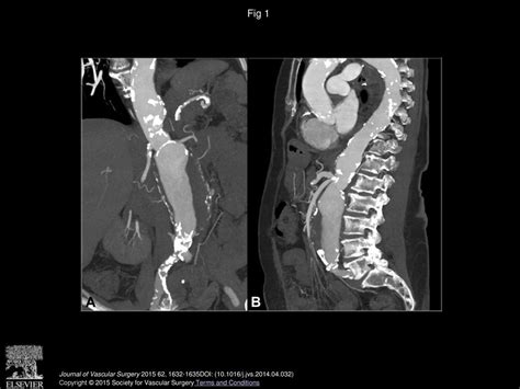 Severe Visceral Ischemia And Death After Multilayer Stent Deployment For The Treatment Of A