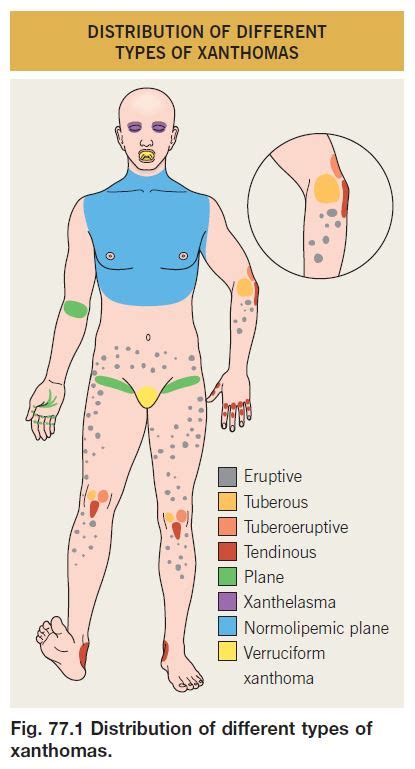 Plane Xanthoma