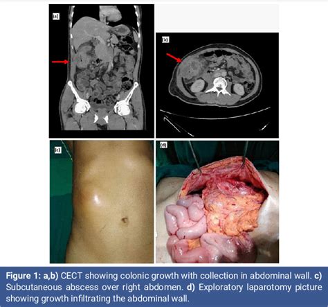 Abdominopelvic Abscess Abdominal Abscesses And Gastrointestinal