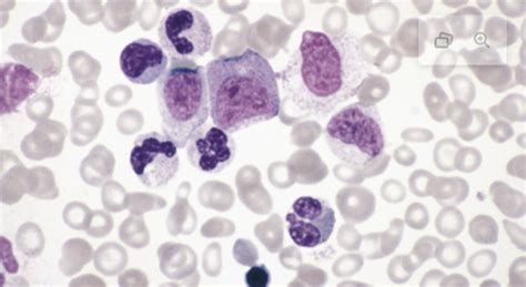 Hematology Ch 12 And 13 Flashcards Quizlet Hematology Ch 12 And 13 Flashcards Quizlet