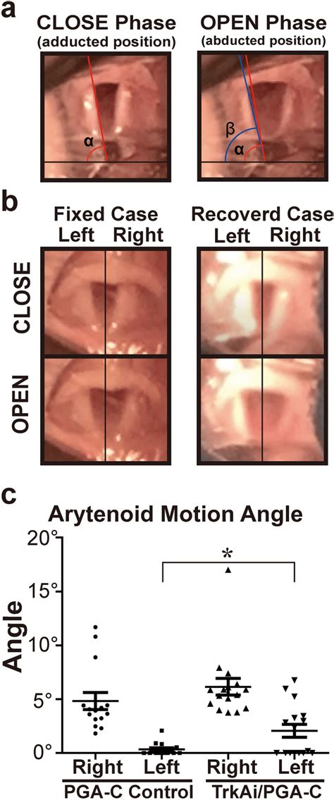 Assessment Of Left Arytenoid Mobility At 14 Weeks After Surgery A