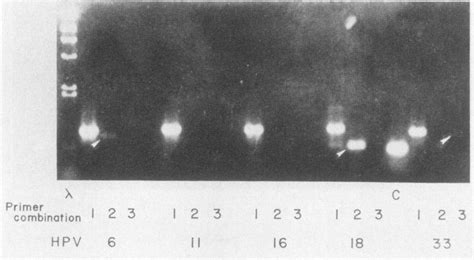 Amplification Of Hpv Dnas Using Different Universal Primer