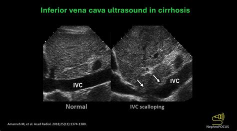 Hemodynamic Pocus In Cirrhosis Think Beyond The Ivc Nephropocus