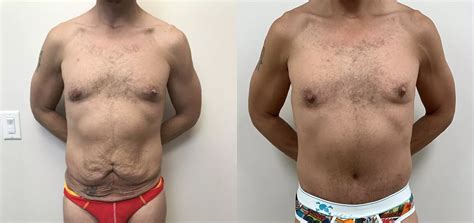 Circumferential Body Lift Before And After Case 391 Renee Burke Md
