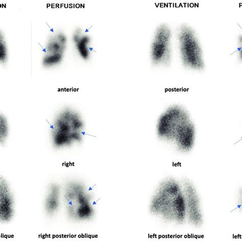 A Plot Graph For Correlation Between Svs Method And Meyer Score For