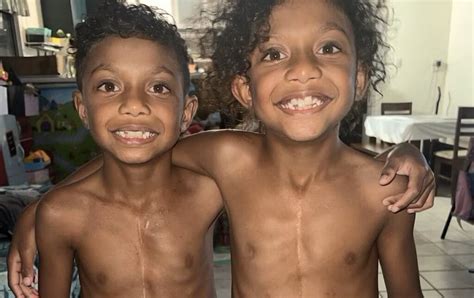 These Twins Are Thriving 10 Years After Open Heart Surgery At
