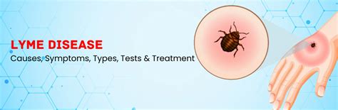 Lyme Disease Causes Symptoms Types Tests And Treatment Guide