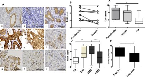 High Agr2 Protein Is A Feature Of Low Grade Endometrial Cancer Cells