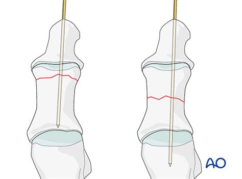 K Wire Fixation For Diaphyseal And Extraarticular End Segment Fractures Of The Proximal Hallux