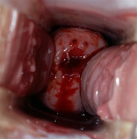 Age 25 Iud And Ectropion Most Of Cycle Beautiful Cervix Project