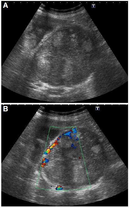 Hepatocellular Carcinoma Ultrasound