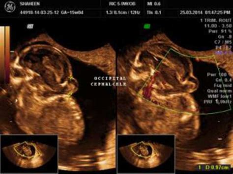Antenatal Ultrasound Diagnosis Of ‘iniencephaly Apertus Isge
