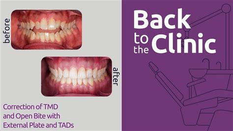 Correction Of Tmd And Open Bite With External Plate And Tads Btc 012