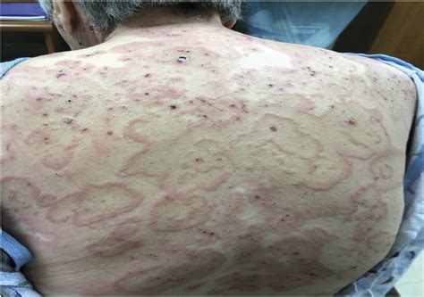 Persistent Arcuate Annular Rash Challenge The American Journal Of