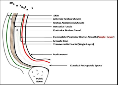Boundaries Of The Classical Retropubic Space Retzius In Presence Of A