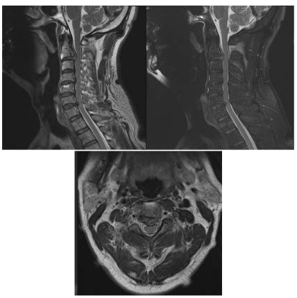 Hangmans Fracture Caused By A Truck Cabin Tilting Backward A Case Report