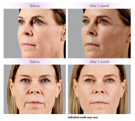 Juvederm Voluma Cheek Augmentation Dermal Filler Cheeks Lift Volume In