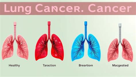 The Connection Between Lung Cancer Symptoms And Stages Careyourlungs