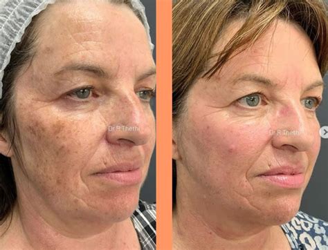 Sun Damage And Pigmentation Neogen Plasma