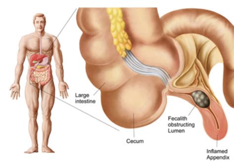 Exam 2 Intestinal Disorders Flashcards Quizlet