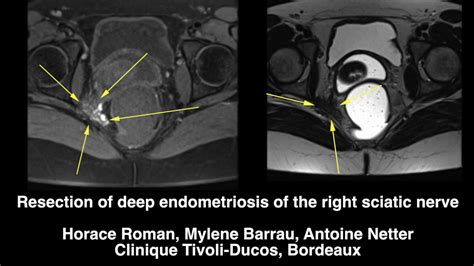Deep Endometriosis Of Sciatic Nerve Anatomy And Resection Youtube