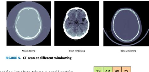 Figure 1 From Intracranial Hemorrhage Classification From Ct Scan Using