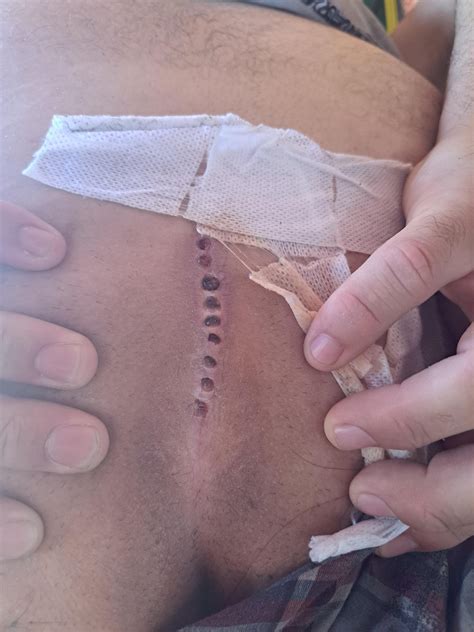 Is Pit Picking Definitely Not The Way Rpilonidalcyst