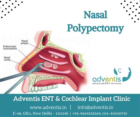 Nasal Polypectomy Treatment In Delhi Surgery And Cost Adventis
