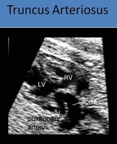 Truncus Arteriosus Echo