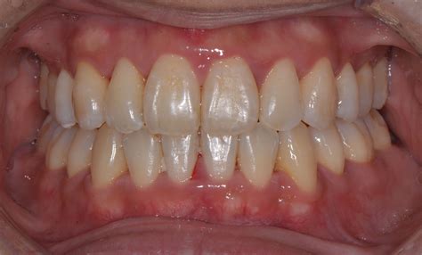 Case Gallery Clearcorrect