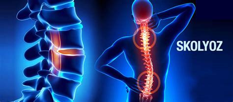 3d Skolyoz Fiztoterapist Ceyda Tunç