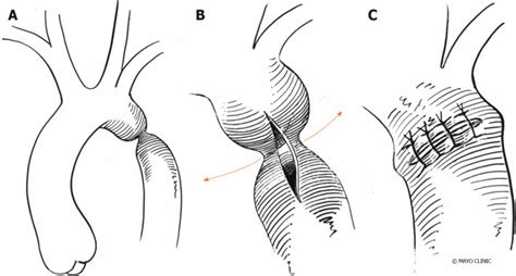 Management Of Adults With Coarctation Of Aorta Abstract Europe Pmc