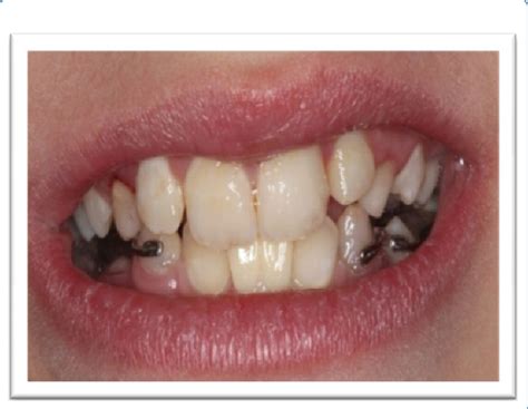 Temporary Partial Prosthesis Of The Patient 2 Download Scientific